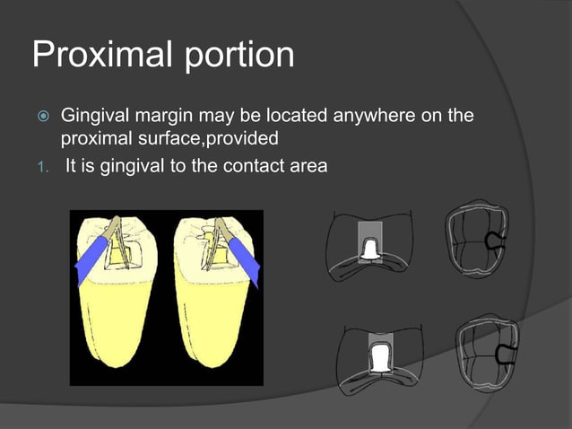 Modifications of Class 2 Cavity preparations | PPTX | Oral care ...