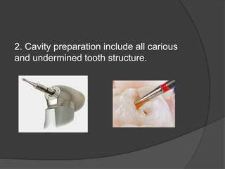 Modifications of Class 2 Cavity preparations | PPTX