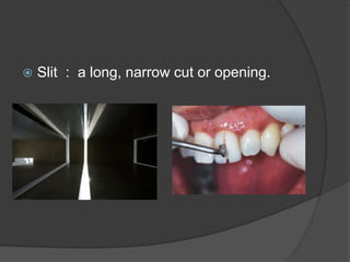 Modifications of Class 2 Cavity preparations | PPTX