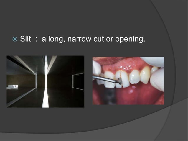 Modifications of Class 2 Cavity preparations | PPTX | Oral care ...