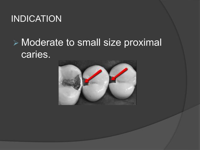 Modifications of Class 2 Cavity preparations | PPTX | Oral care ...