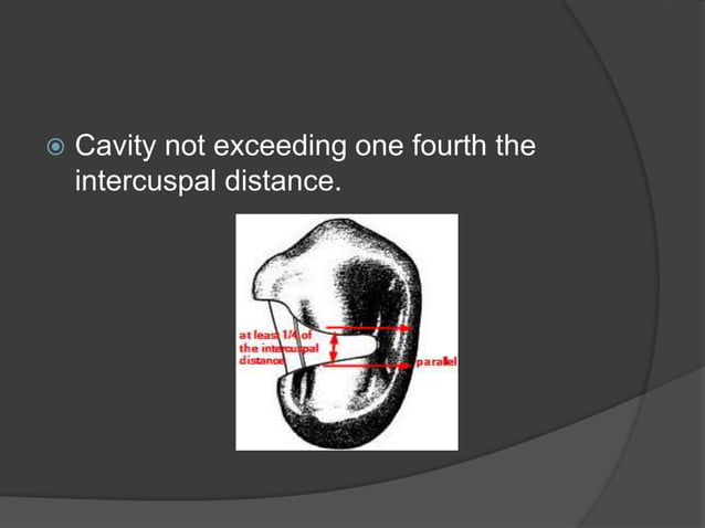 Modifications of Class 2 Cavity preparations | PPTX | Oral care ...