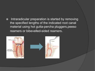 Modifications of Class 2 Cavity preparations | PPTX