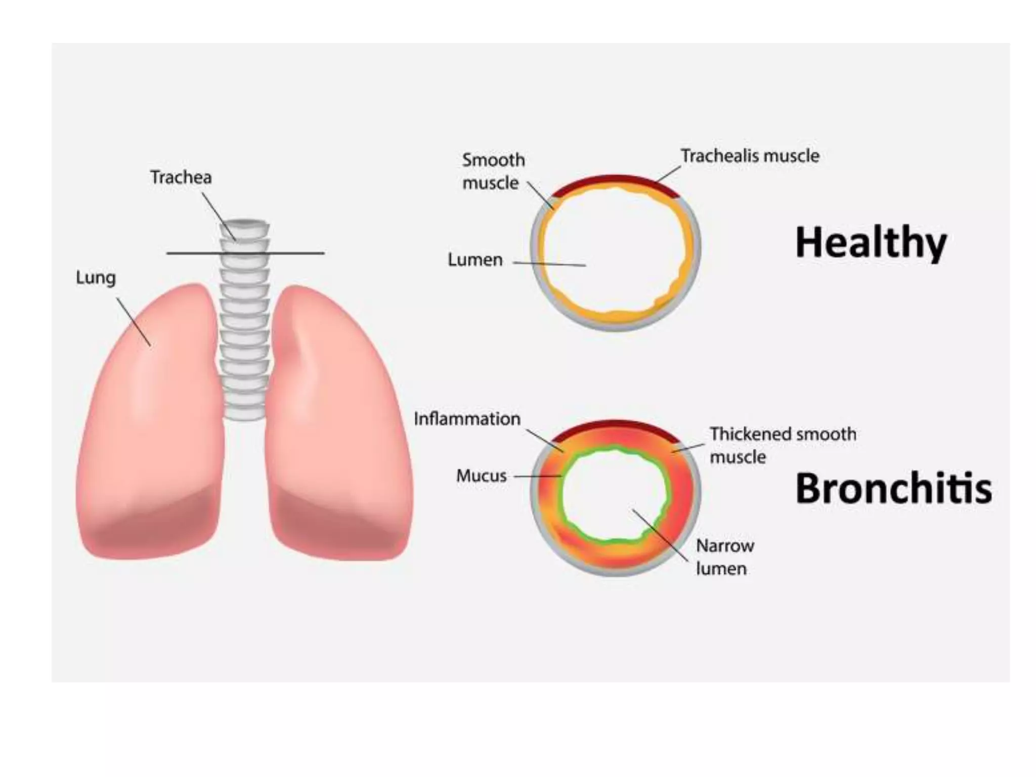 obstructive bronchitis | PPTX