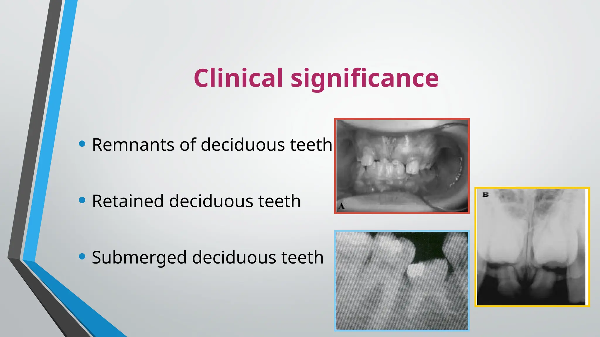 SHEDDING OF TEETH - INTRODUCTION AND HISTOLOGY | PPTX