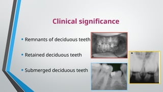 SHEDDING OF TEETH - INTRODUCTION AND HISTOLOGY | PPTX