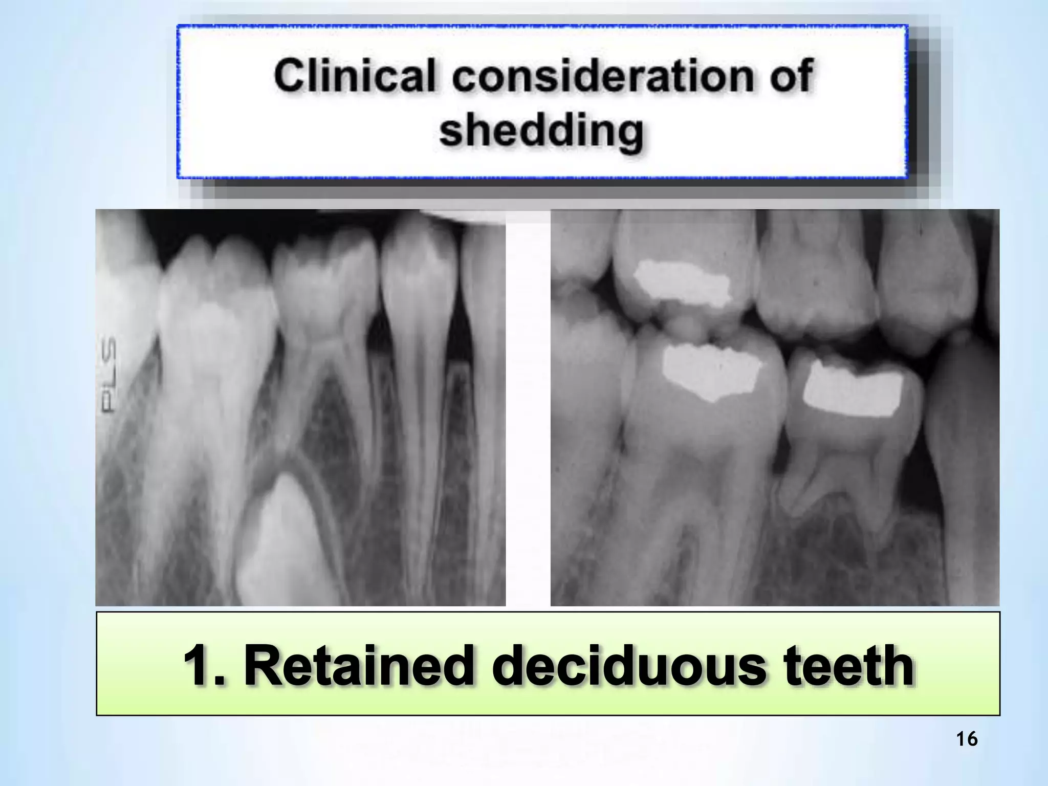 Shedding of deciduous teeth. | PPTX