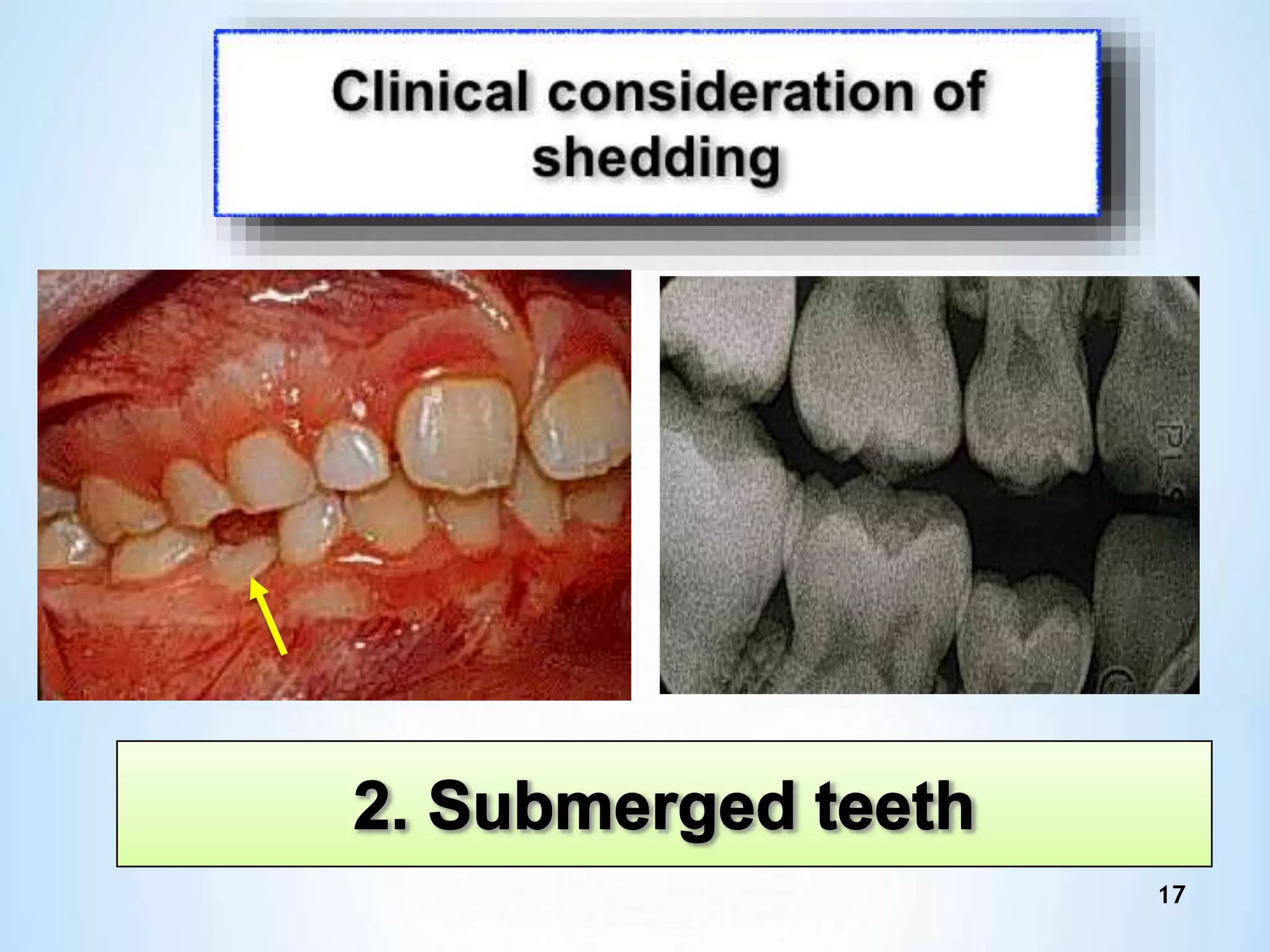 Shedding of deciduous teeth. | PPTX