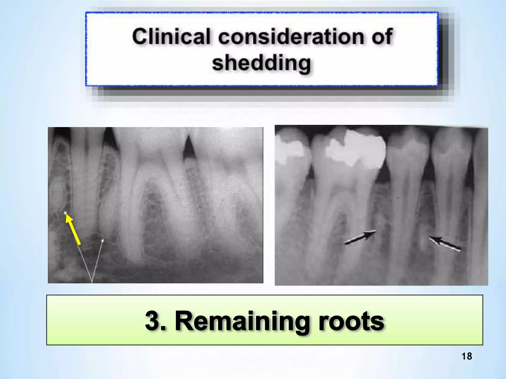 Shedding of deciduous teeth. | PPTX