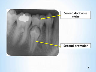 Shedding of deciduous teeth. | PPTX