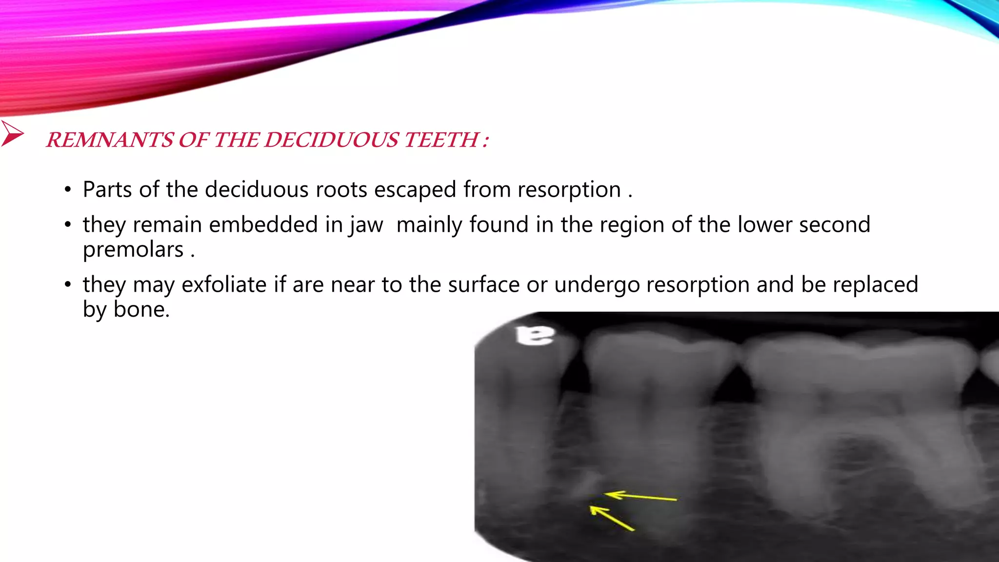 Shedding of the deciduous teeth | PPTX