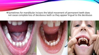Shedding of the deciduous teeth | PPTX
