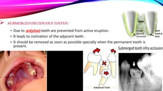 Shedding of the deciduous teeth | PPTX