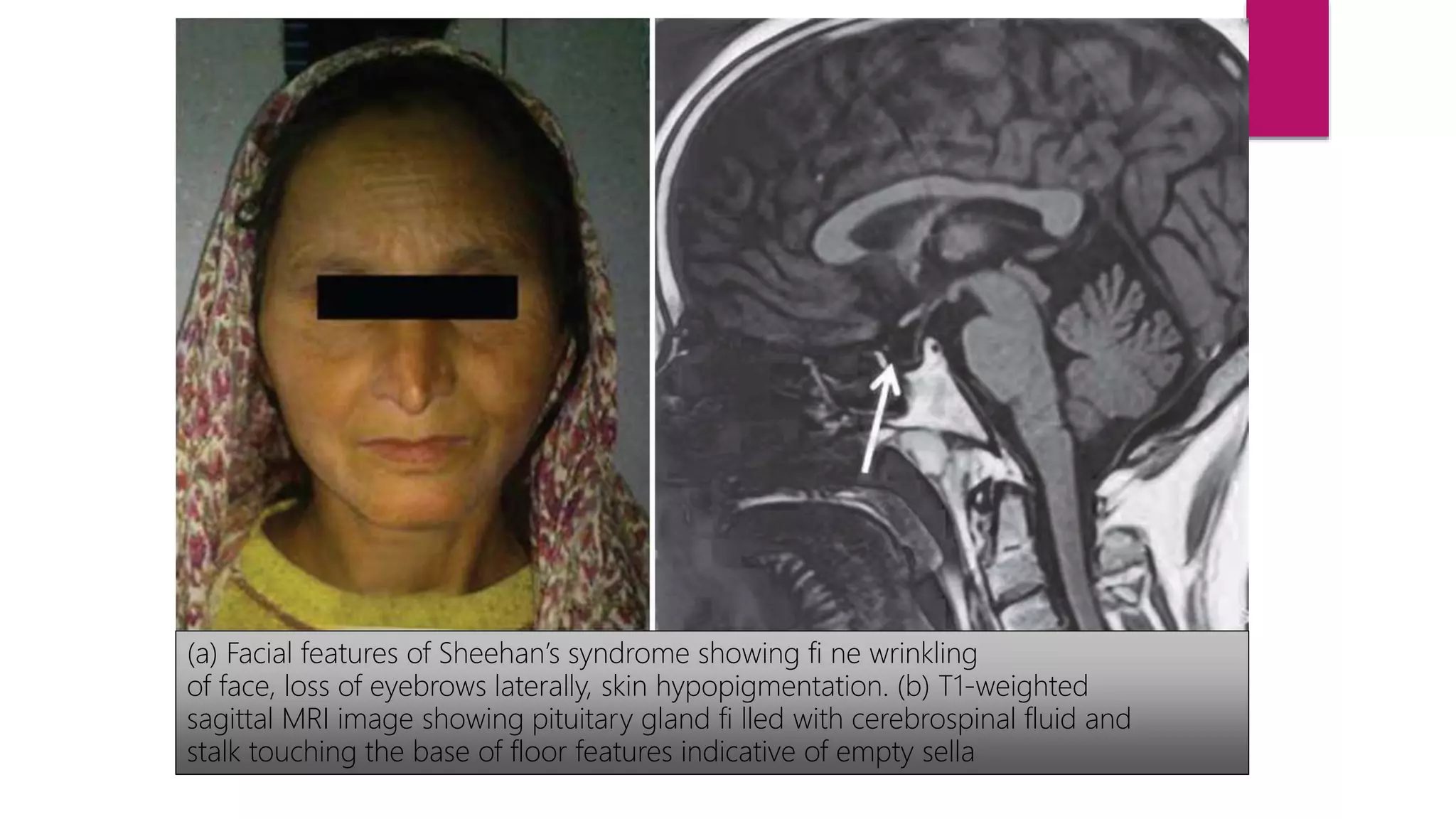 Sheehan's syndrome | PPTX