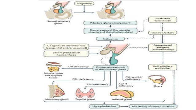 Sheehan's syndrome