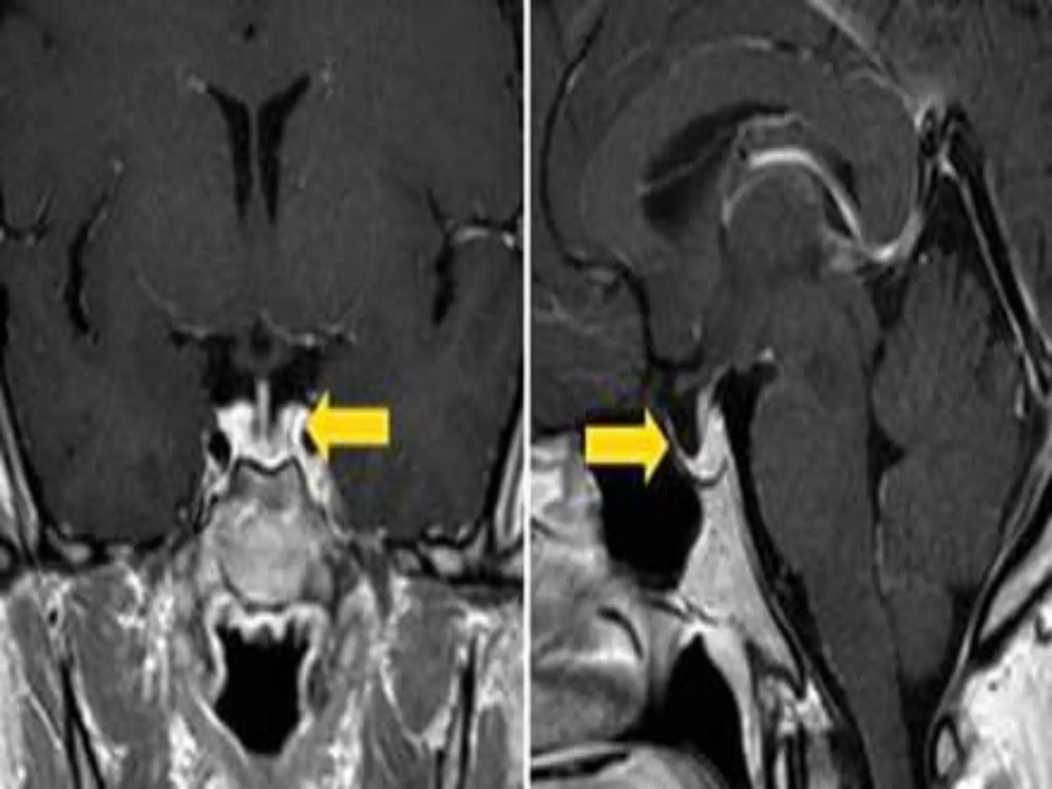 Sheehan's syndrome and simmond's syndrome | PPTX