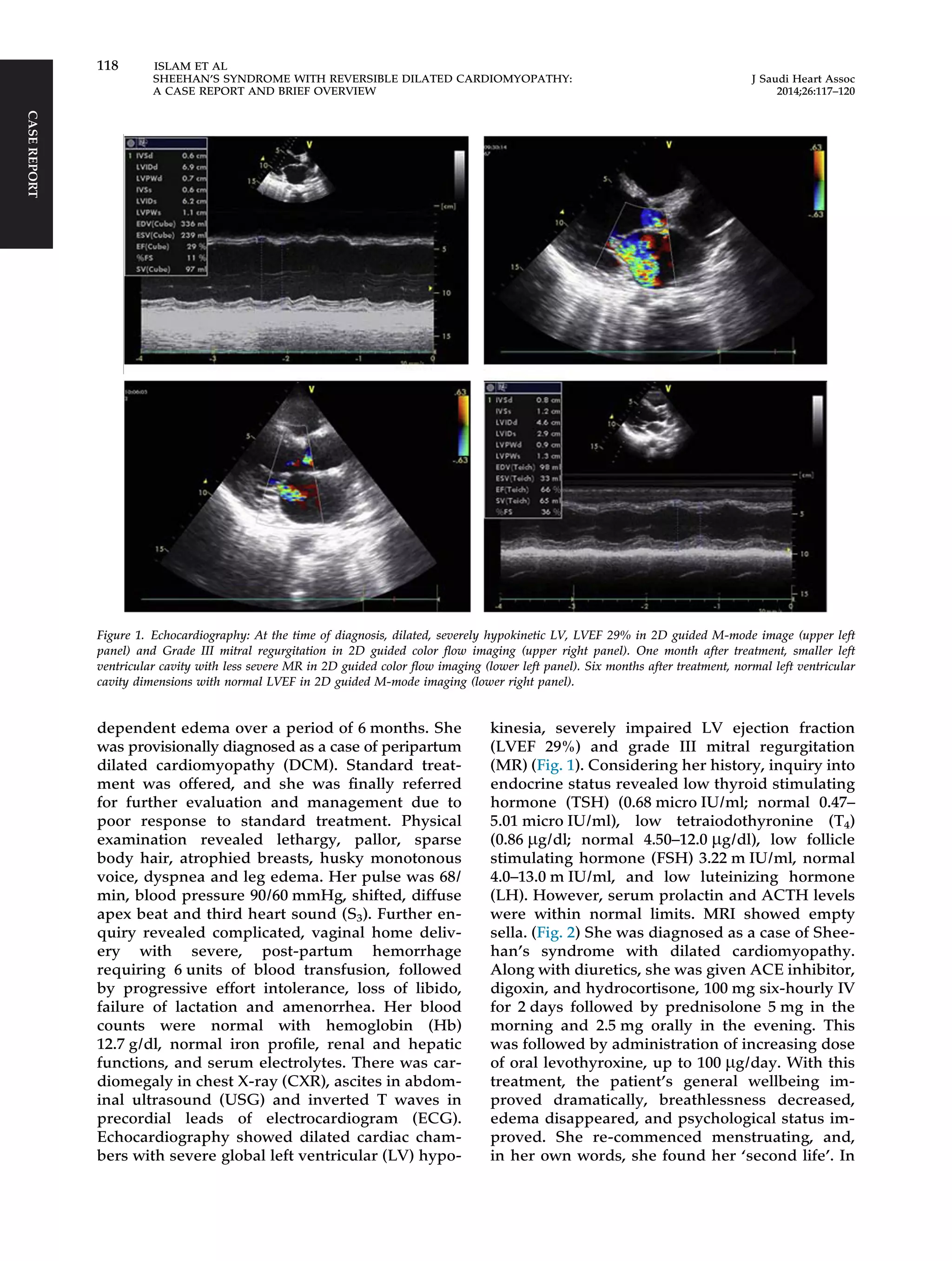 Sheehans Syndrome With Reversible Dilated Cardiomyopathy A Case