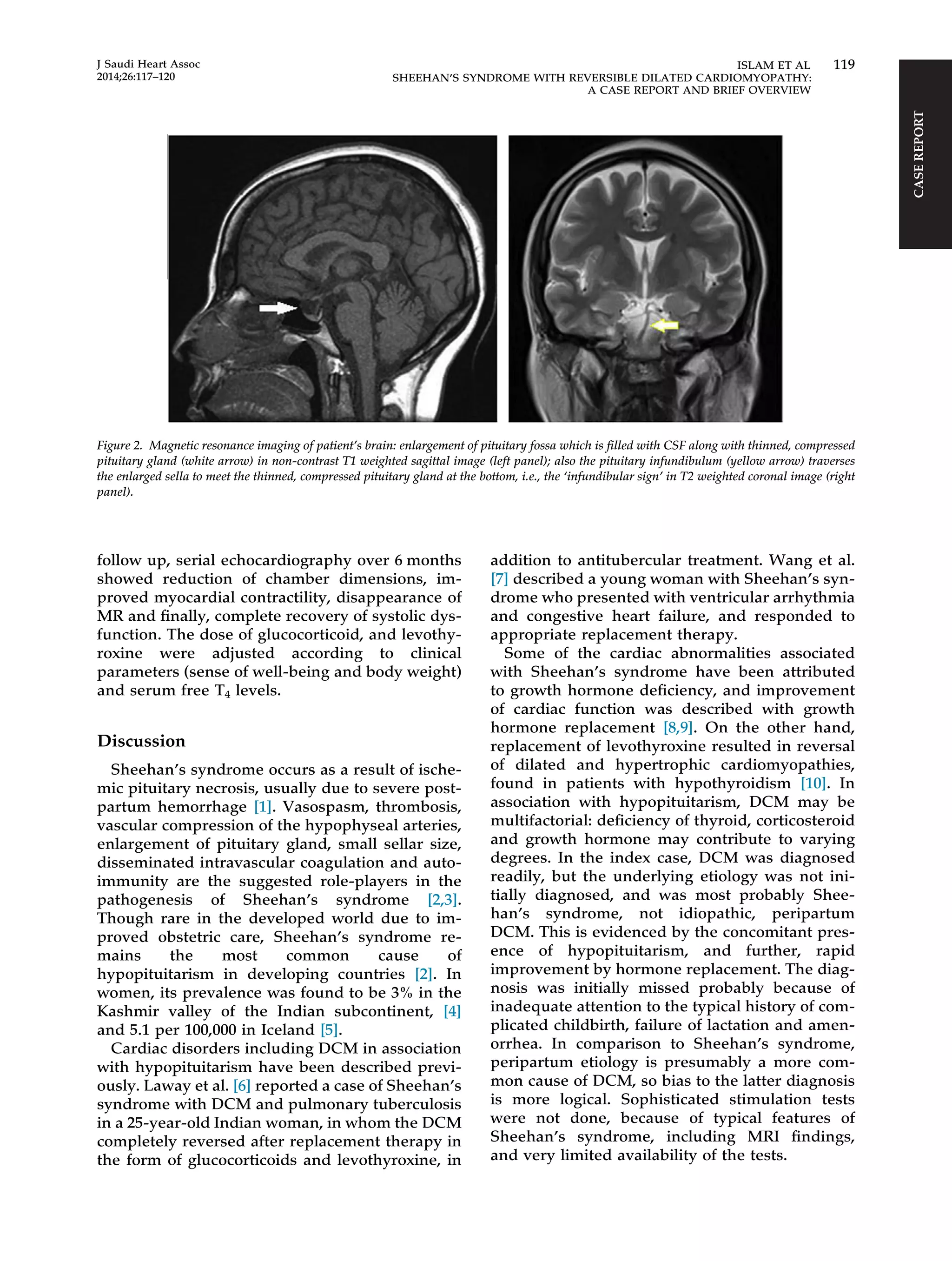 Sheehans Syndrome With Reversible Dilated Cardiomyopathy A Case