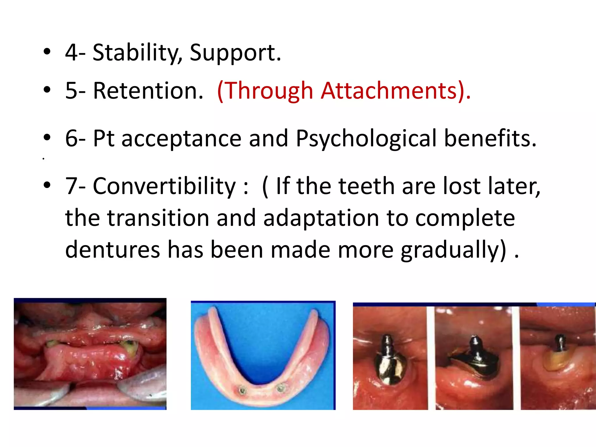 (Overdenture) (1).pdf