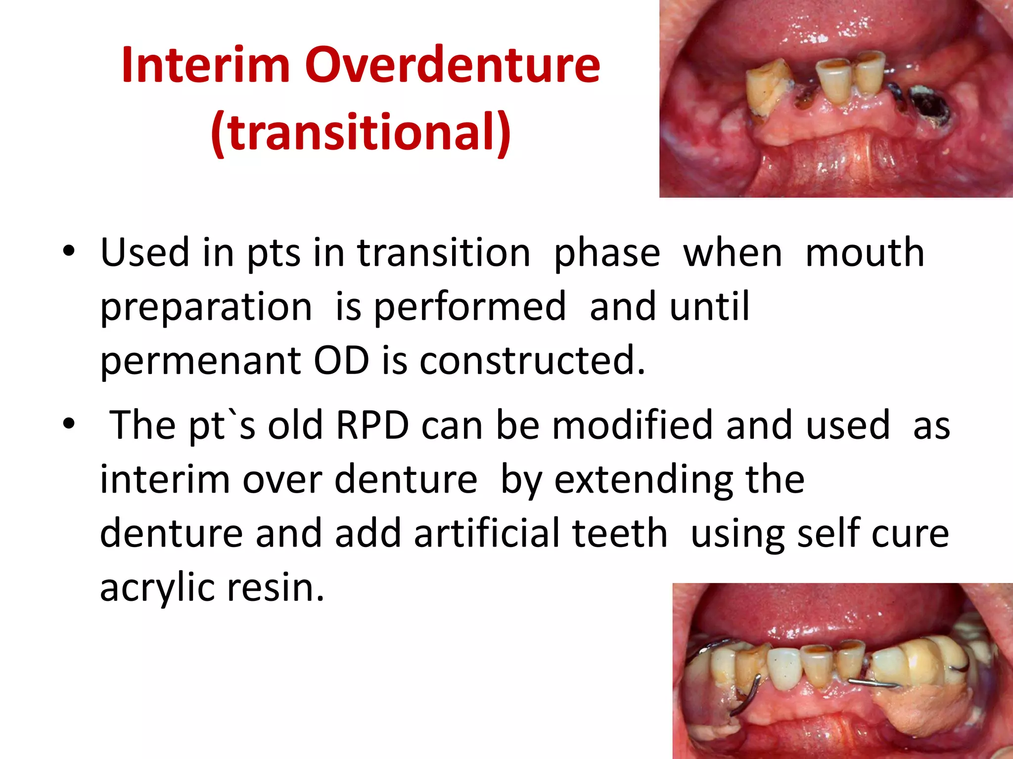 (Overdenture) (1).pdf