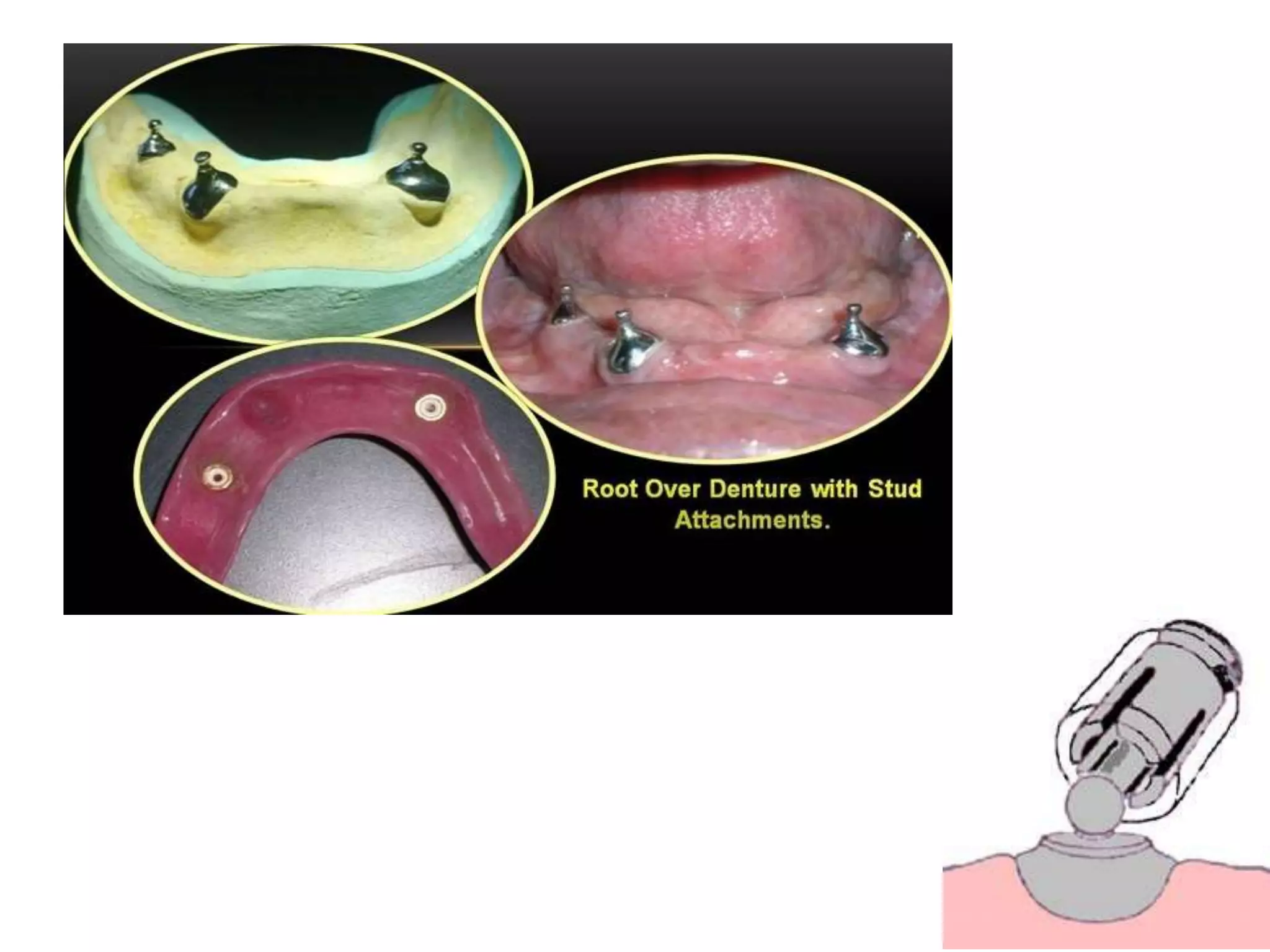 (Overdenture) (1).pdf