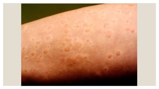 Sheetapitta, udarda and kotha | PPTX