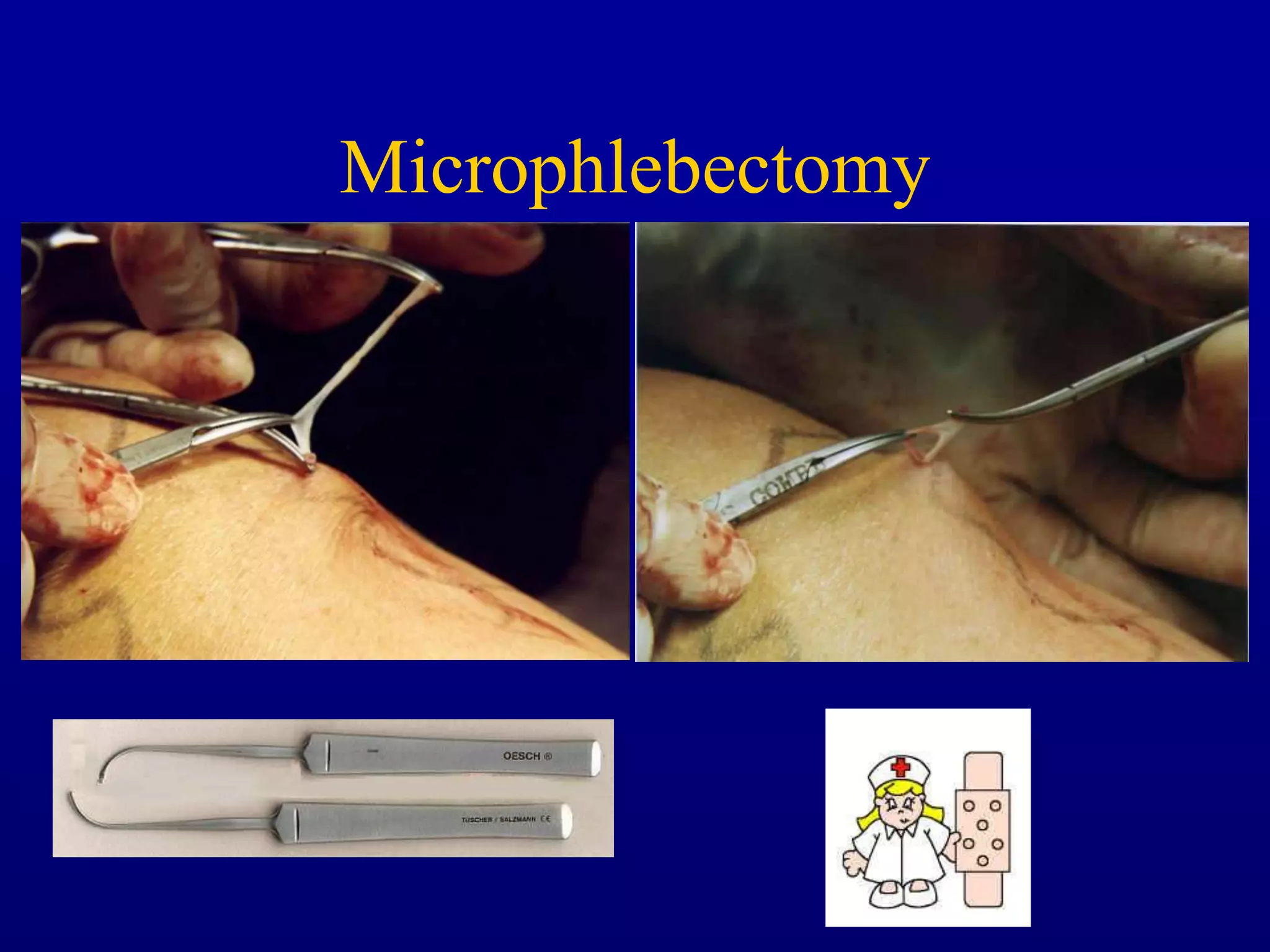 Management of Incompetence in the Axial Veins | PPTX