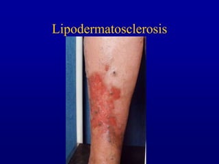 Management of Incompetence in the Axial Veins | PPTX