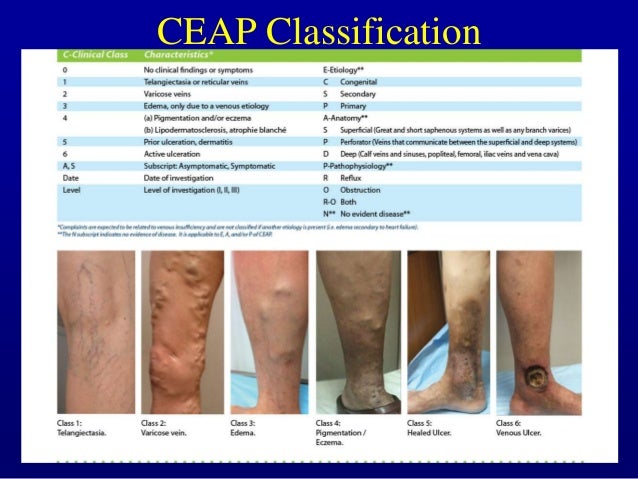 Management of Incompetence in the Axial Veins