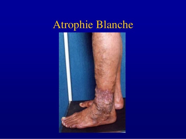Management of Incompetence in the Axial Veins
