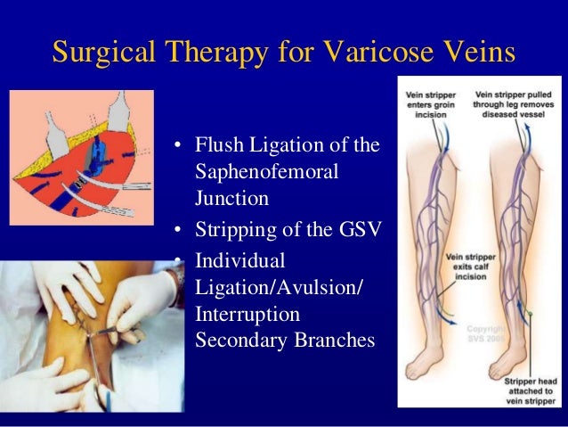 Management of Incompetence in the Axial Veins