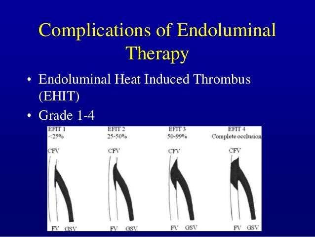 Management of Incompetence in the Axial Veins