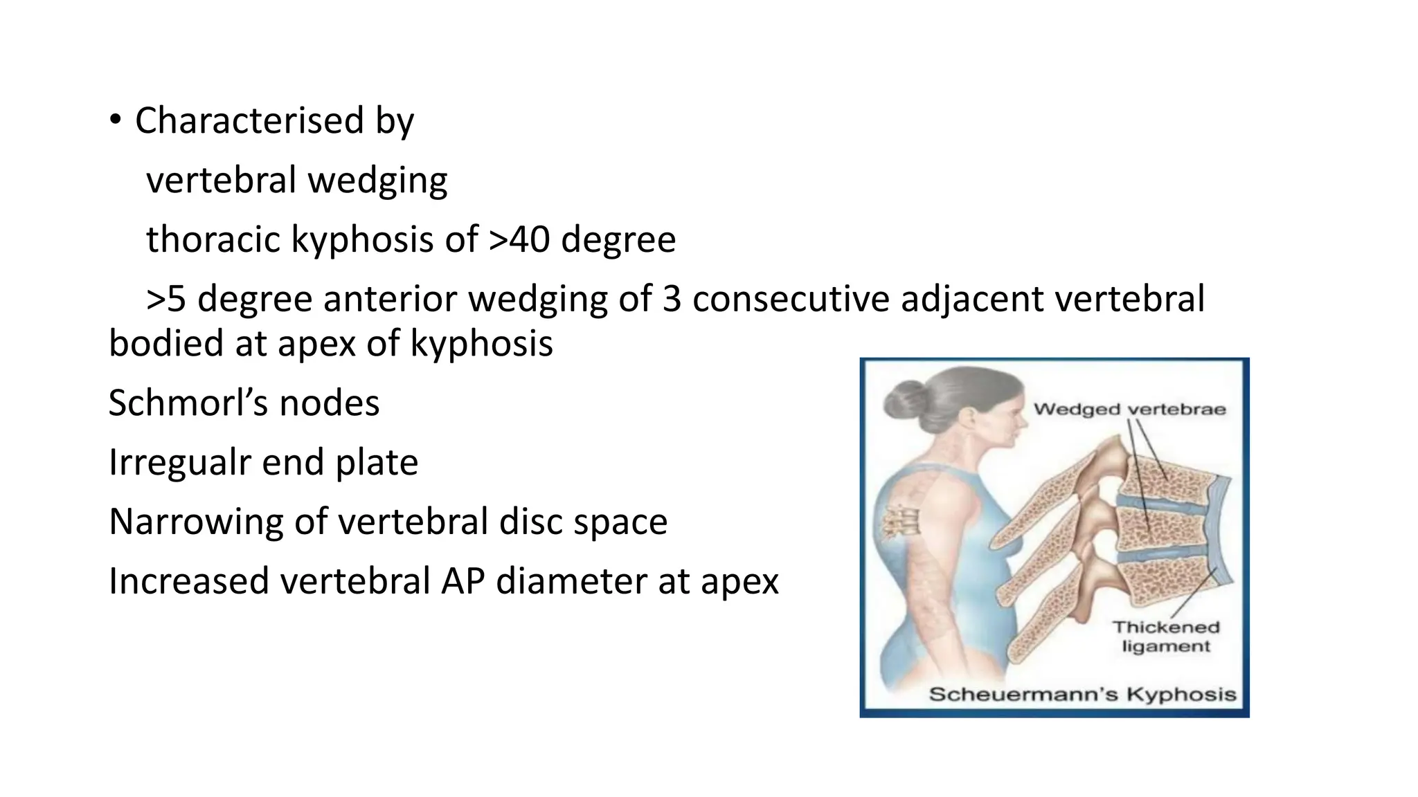 SHEUERMANN+DISEASE.pptx