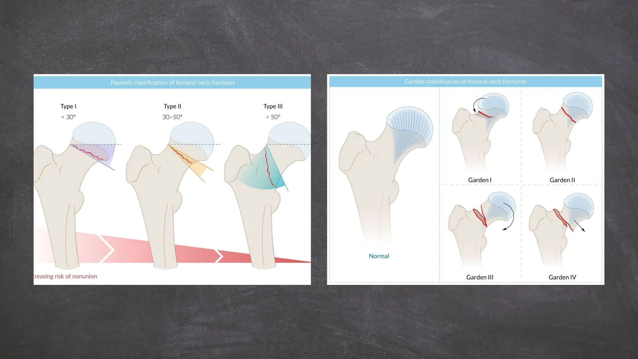 Proximal femur fracture classification ppt | PPTX