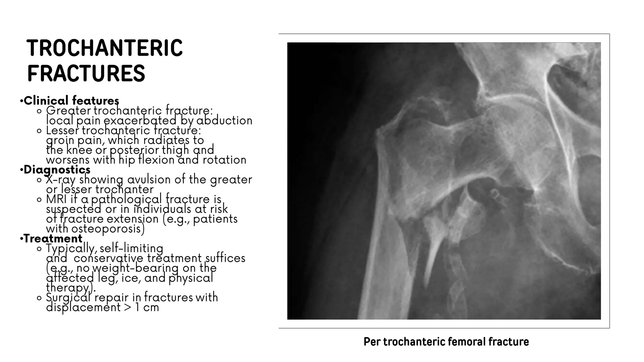 Proximal femur fracture classification ppt | PPTX