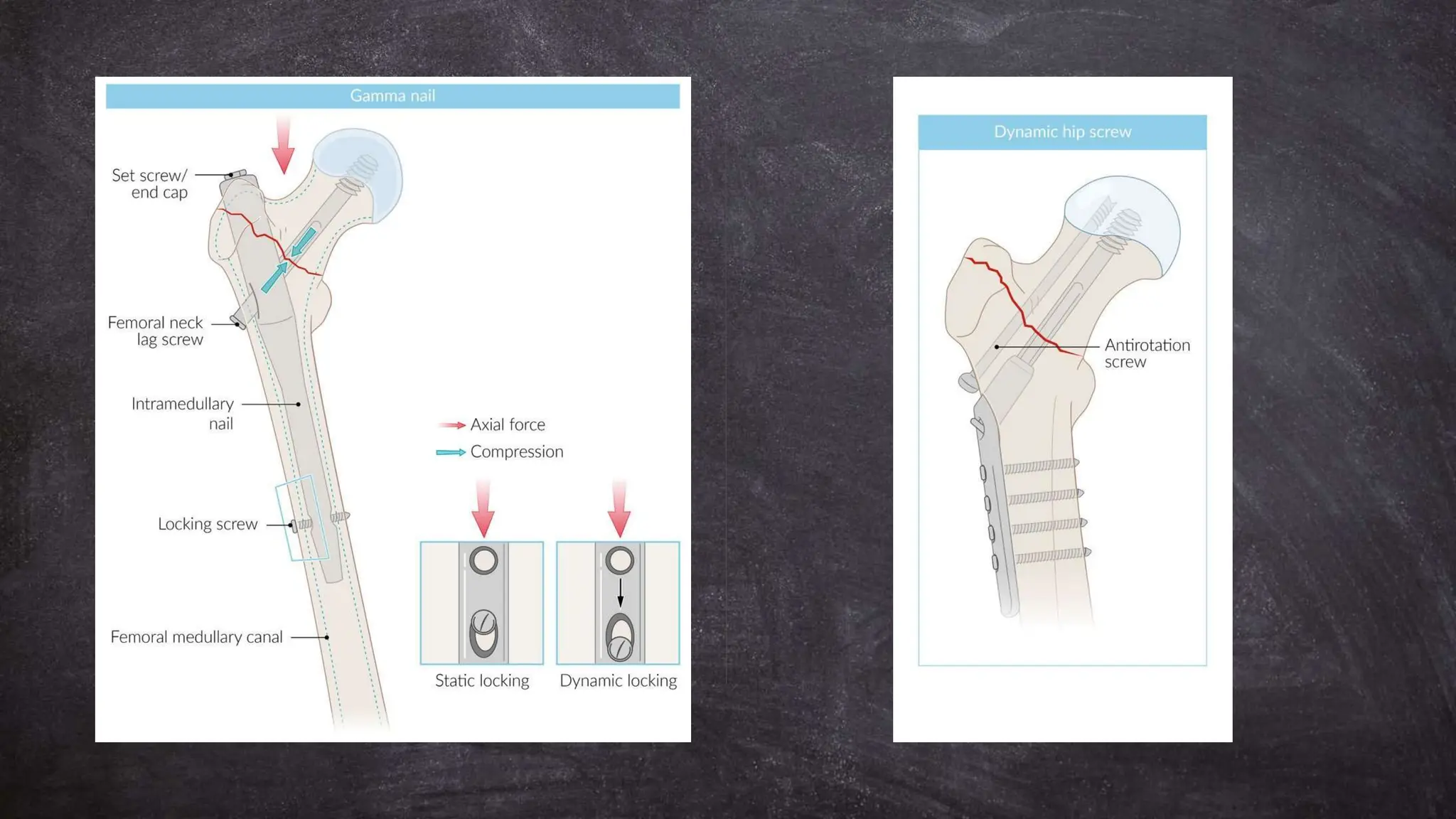 Proximal femur fracture classification ppt | PPTX