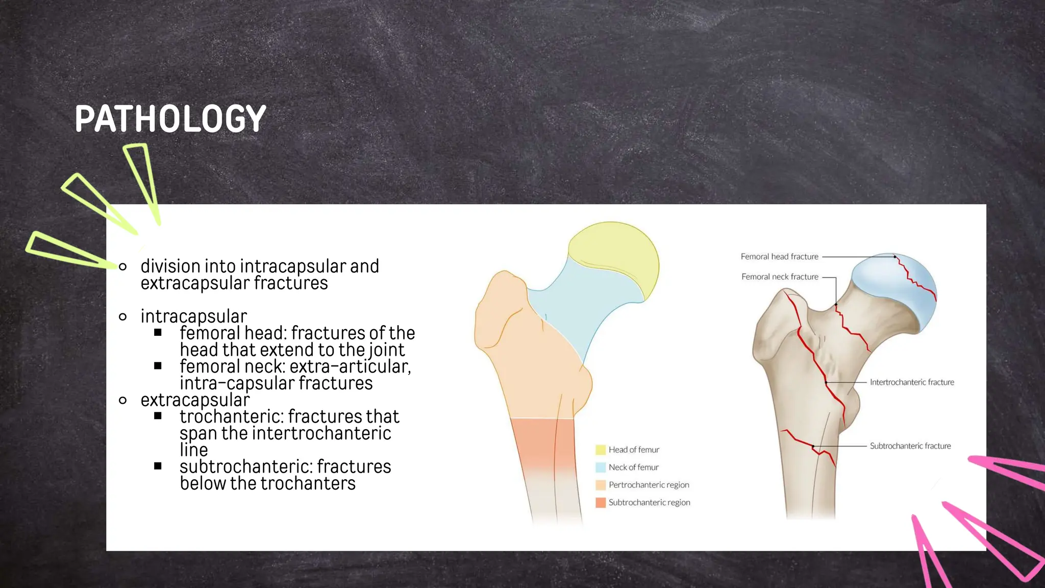 Proximal femur fracture classification ppt | PPTX