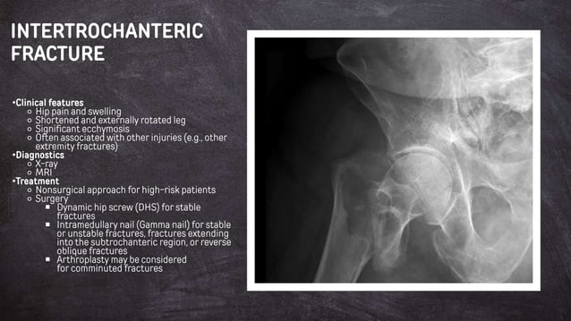 Proximal femur fracture classification ppt | PPTX