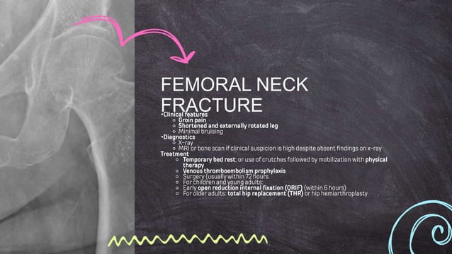 Proximal femur fracture classification ppt | PPTX