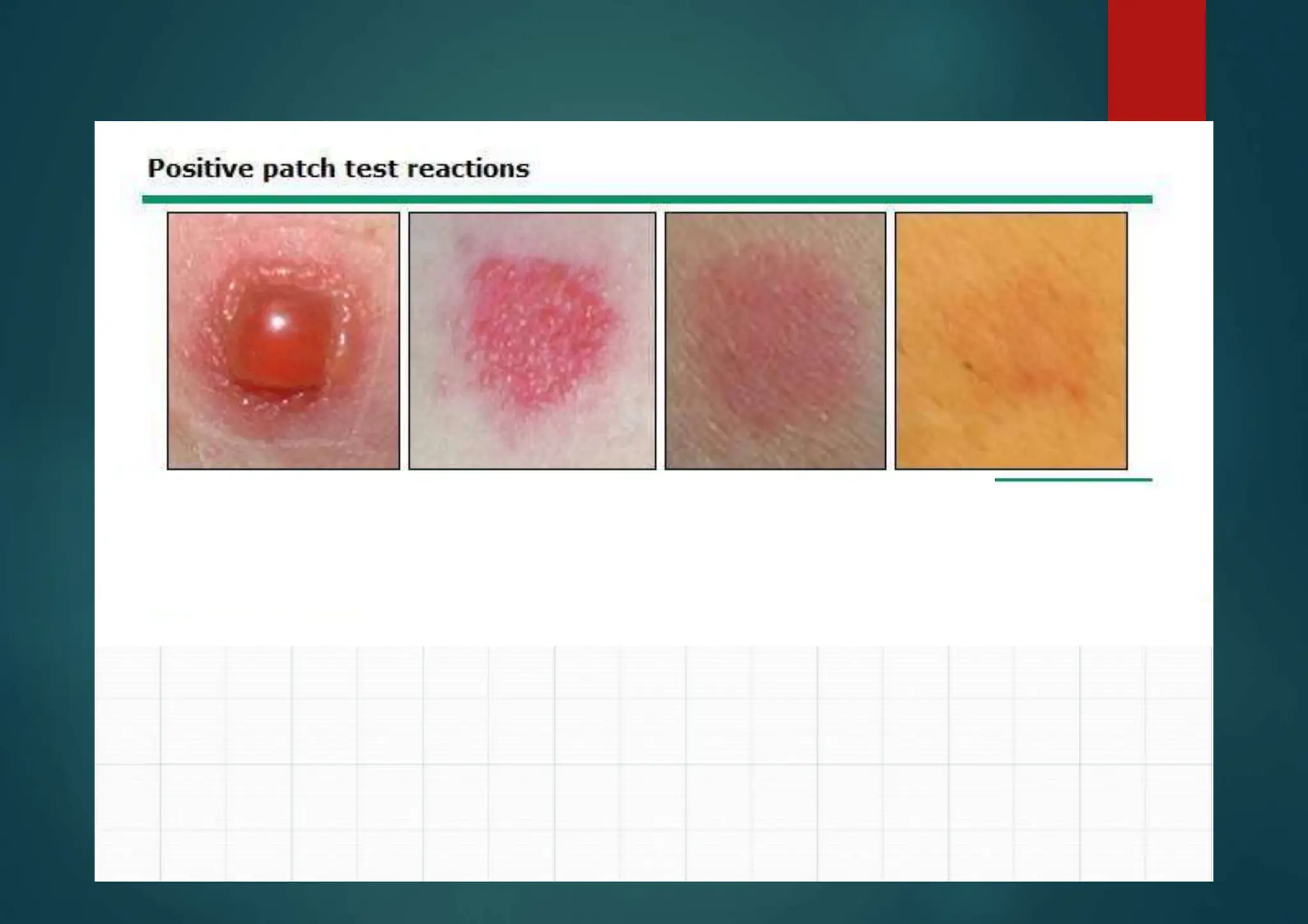 Allergic contact dermatitis shikhar.pptx