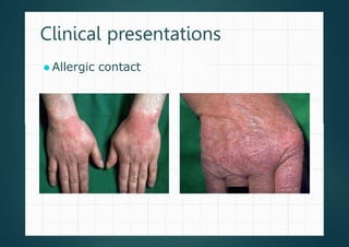 Allergic contact dermatitis shikhar.pptx