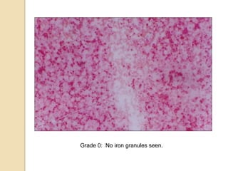 iron staining. | PPTX | Blood Disorders | Diseases and Conditions