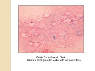 iron staining. | PPTX | Blood Disorders | Diseases and Conditions