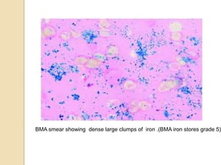 iron staining. | PPTX | Blood Disorders | Diseases and Conditions