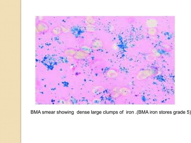 iron staining. | PPTX | Blood Disorders | Diseases and Conditions