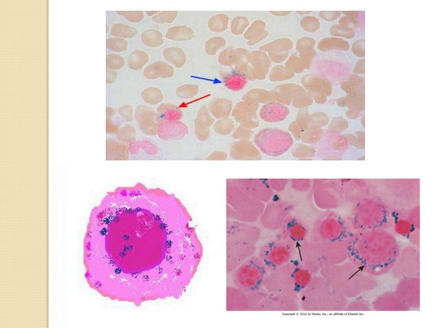 iron staining. | PPTX | Blood Disorders | Diseases and Conditions