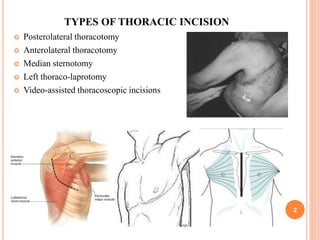 Anterolateral Thoracotomy
