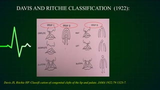 CLEFT LIP AND PALATE | PPTX