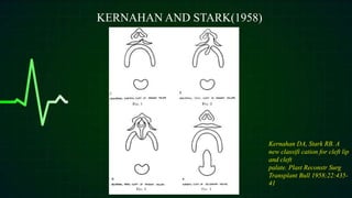 CLEFT LIP AND PALATE | PPTX