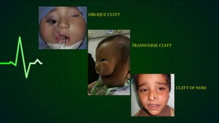 CLEFT LIP AND PALATE | PPTX
